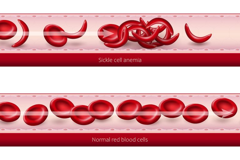 Understanding Sickle Cell Anemia: Causes, Symptoms and Treatment ...