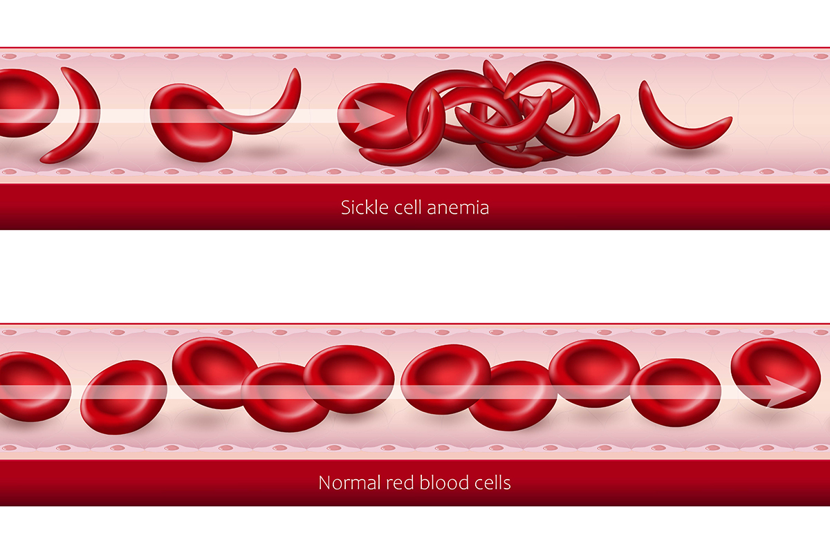 Understanding Sickle Cell Anemia: Causes, Symptoms and Treatment ...