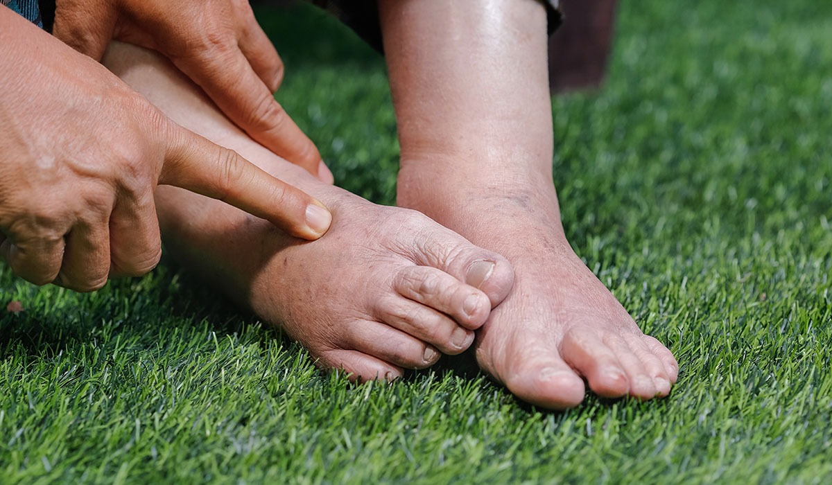 Understanding Chronic Venous Insufficiency: A Q&A with Dr. Khanjan ...